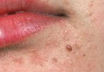 Skin Tags on the Face? Safest Products for Removing a Facial Skin Tag