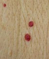 What Are Red Skin Tags & Can They Be Safely Removed?