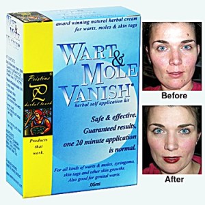 How to Safely Burn Off Skin Tags – Skintagsgone.com