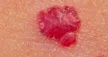 Understanding the Different Types of Benign Skin Growths