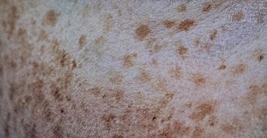 Understanding the Different Types of Benign Skin Growths