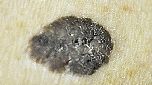 Understanding the Different Types of Benign Skin Growths