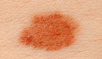 Understanding the Different Types of Benign Skin Growths