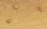 How Do I Clear Up Skin Tags That Itch? – Skintagsgone.com