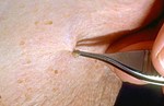 Guide to Cutting Off Skin Tags Safely at Home – Skin Tags Gone