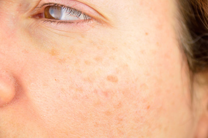 Mole vs. Freckle: 10 Ways to Tell the Difference
